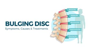 Bulging Disc | Symptoms, Causes & Treatments