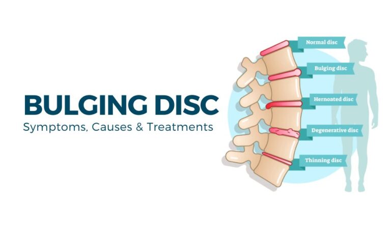 Bulging Disc | Symptoms, Causes & Treatments