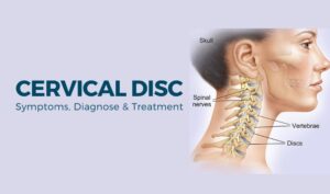 Cervical Disc | Symptoms, Diagnosis & Treatment