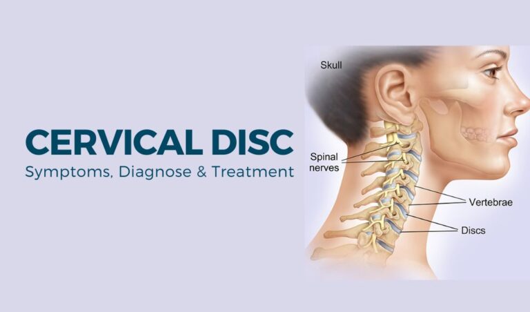 Cervical Disc | Symptoms, Diagnosis & Treatment